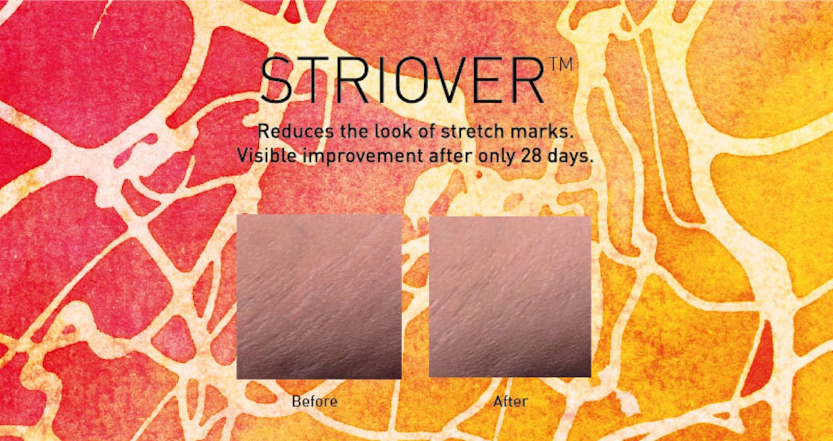 Striover™ Minimizes the Appearance of Stretch Marks | Global Cosmetic ...